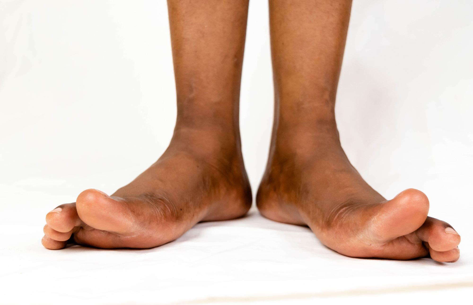 Corn + Callus removal – Foot Fine Care